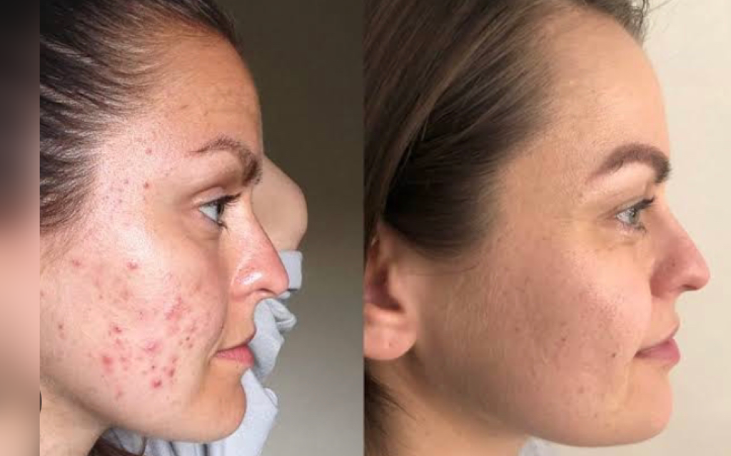 How To Get Rid Of Oily Skin And Pimples Naturally - School Drillers